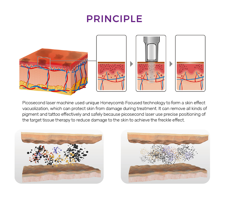 450PS True Picosecond Laser Pigment Removal Machine - Buy Pigment ...