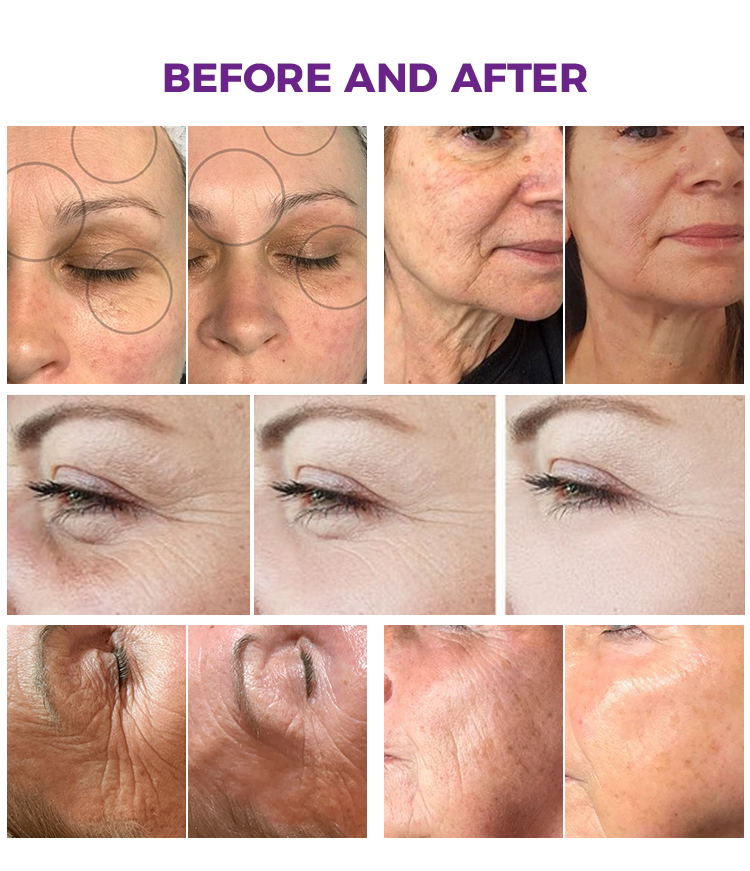 Rf Tightening Lift EMS Facial Electromagnetic Stimulation Machine - Buy ...