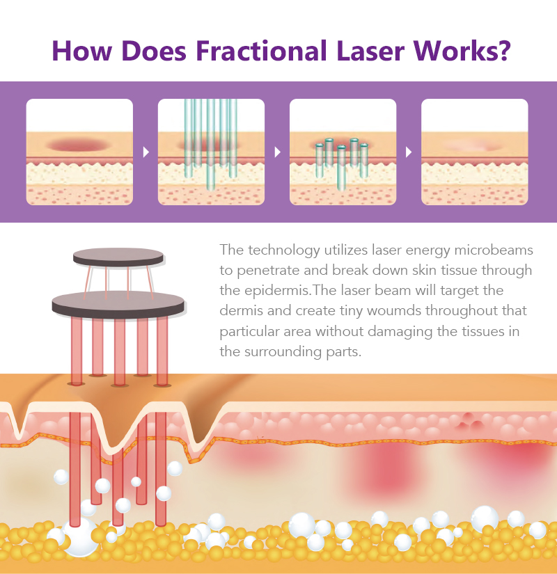 Newangie® Co2 Fractional Laser Skin Resurfacing Scar Removal Machine ...